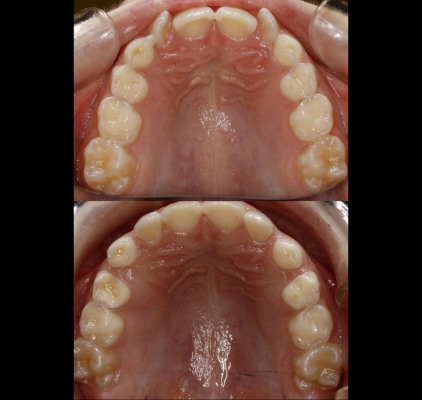 Invisalign Expansion