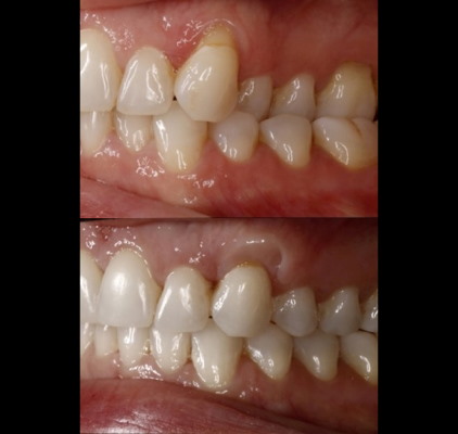 Invisalign Expansion