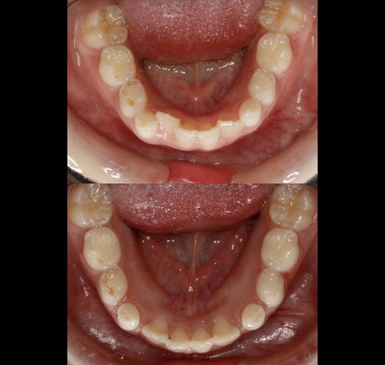 Invisalign Expansion