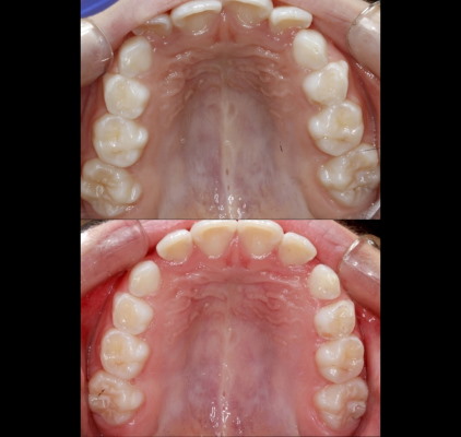Invisalign Expansion