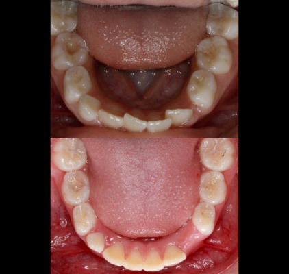 Invisalign Expansion