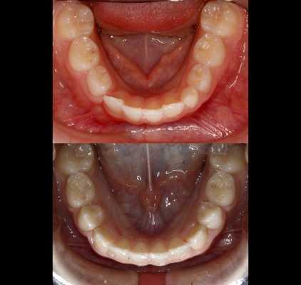 Invisalign Expansion
