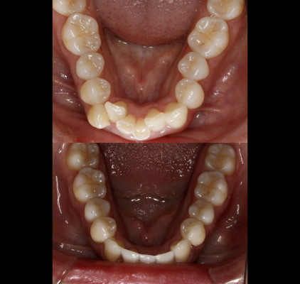 Invisalign Adult