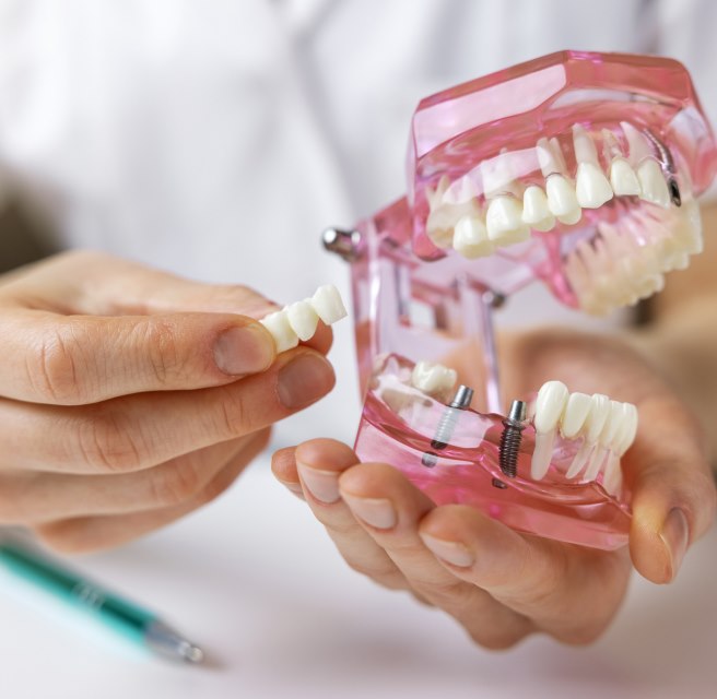 Temporary Anchoring Devices | Douglas Knight Orthodontics