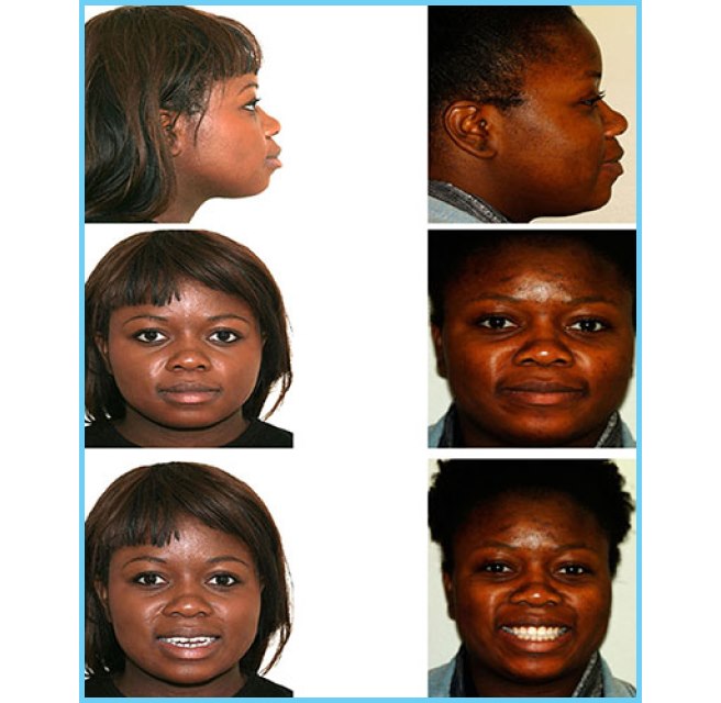 Before & After | The Office of Dr. Douglas J. Knight | Tacoma Washington